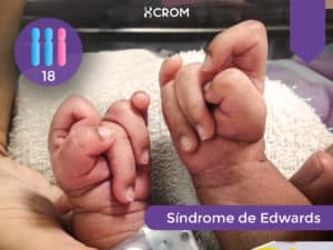 Ficha técnica: Síndrome de Edwards – CROM – Instituto de Citogenética ...