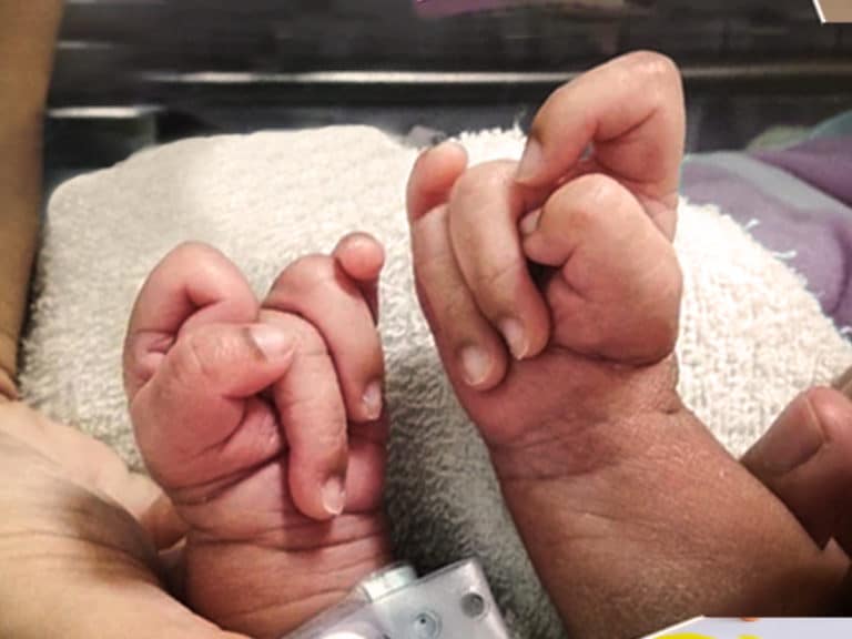 Ficha técnica: Síndrome de Edwards – CROM – Instituto de Citogenética ...