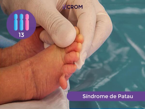 Ficha técnica: Síndrome de Patau – CROM – Instituto de Citogenética Humana